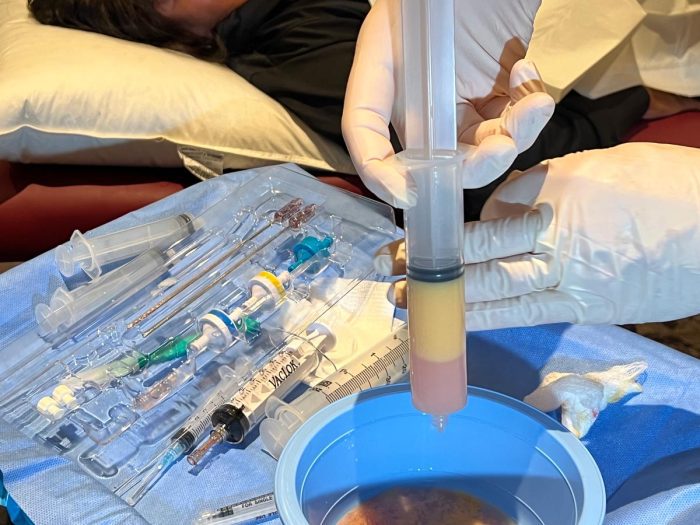 Adipose Stem Cell Therapy Phoenix & Scottsdale